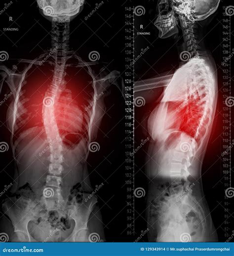 X Ray Image Of Whole Spine Scanography Ap And Lateral View Stock