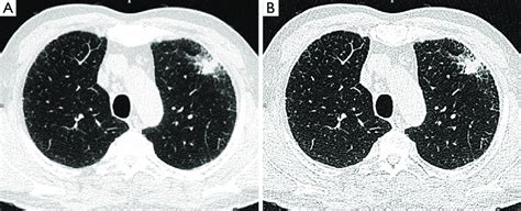 Example Of Low Dose Ct Protocol With 120 Kvp And Fbp Reconstructed With