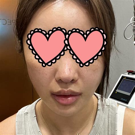 의사에게 물어보세요 코수술후 이런 코에 강남언니 1등 성형수술and피부시술 정보앱