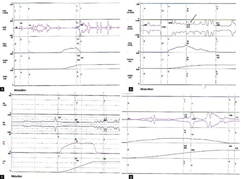 Different Types Of Uroflow Uf With Electromyography Emg Patterns