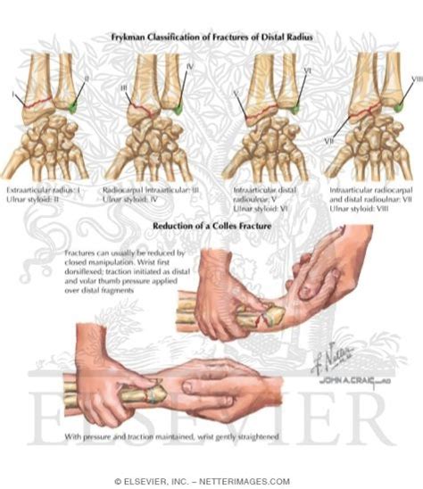 Colles Fracture Classification