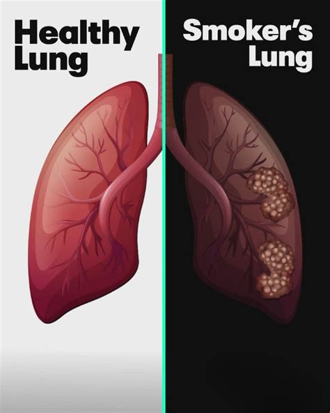 Lungs After Smoking Before And After
