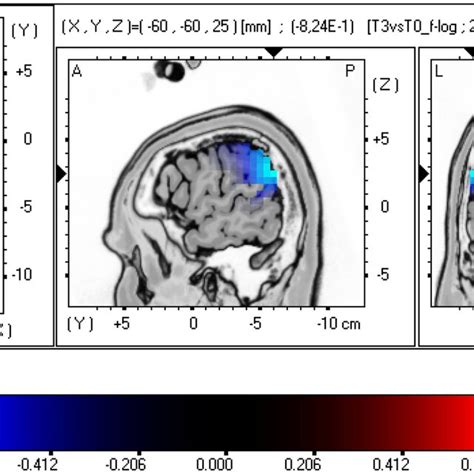 Sloreta Slice Viewer T2 Vs T0 Loreta Statistical Maps Of The