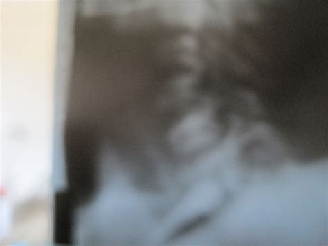 Cervical Osteomyelitis In An Infant Medical Memoirs