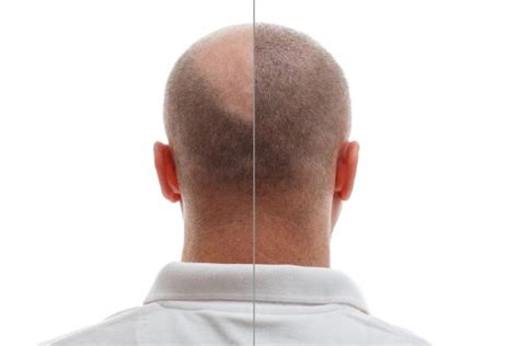 Pimples On The Scalp After A Hair Trasplant Capilclinic