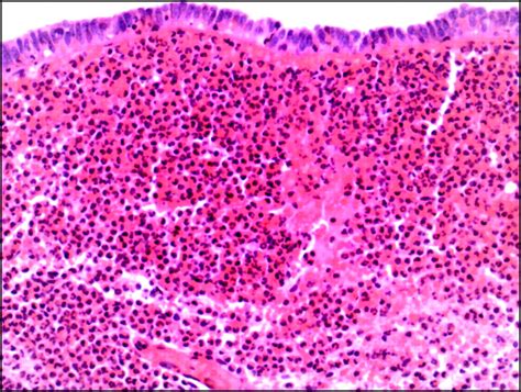 Torsion Of The Testicular Appendix Importance Of Associated Acute Inflammation Journal Of