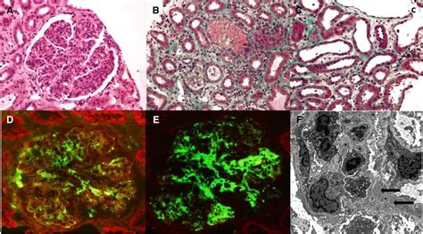 Diffuse Proliferative Glomerulonephritis Em