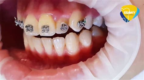 طريقة تركيب تقويم الاسنان Youtube