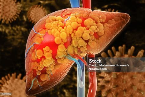 지방간 섬유증 간경변 및 간암과 같은 간 손상 3d 일러스트레이션 3차원 형태에 대한 스톡 사진 및 기타 이미지 3차원 형태 간 내부 기관 간암 Istock
