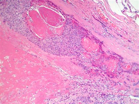 Histopathology Scalp Swelling Histopathology Scalp Swelling