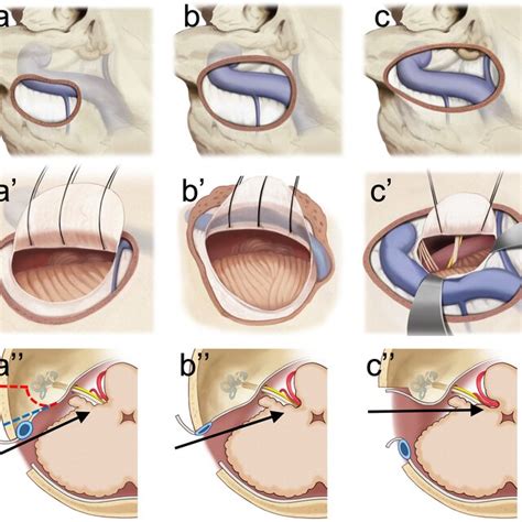 Participant Flow Diagram Mvd Microvascular Decompression Hfs