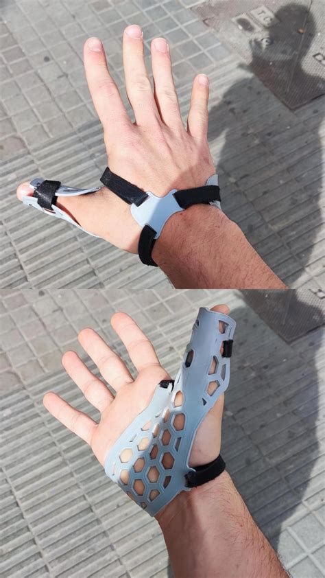 Custom Fit Thumb Splint For Around Cents The Future Of Healthtech