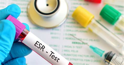 Prueba De Vsg Procedimiento Resultados Y Riesgos Salud Tudo