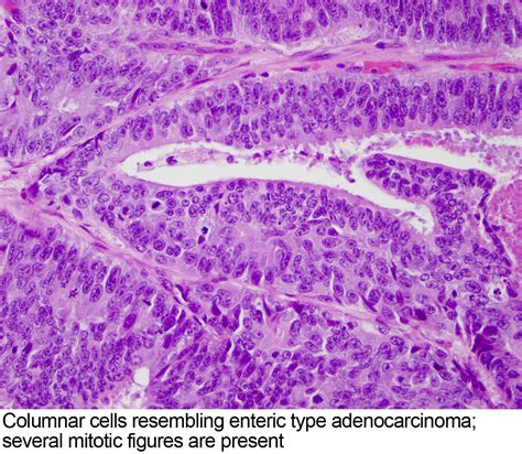 Pathology Outlines Ductal Adenocarcinoma