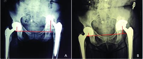 A A Case Of Paproskys Iiib Bone Defect B Radiographic Control 7 Download Scientific Diagram