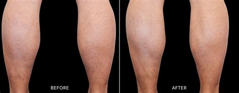 The 4 Most Popular Coolsculpting Areas With Results