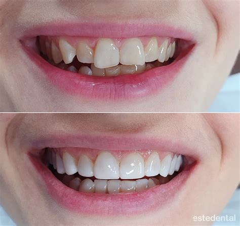 Бондинг цени — Естедентал