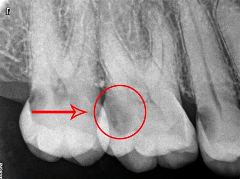 What Does A Cavity Look Like On An X Ray Web Dmd