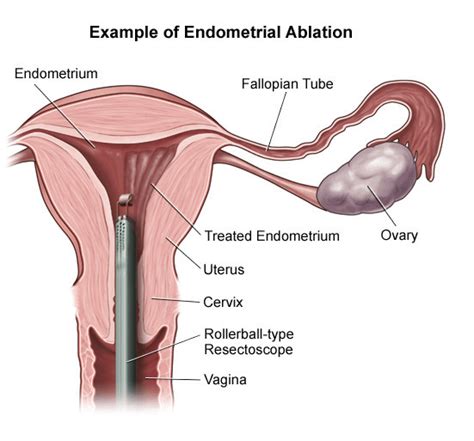 Endometrial Ablation Palomar Health San Diego Ca