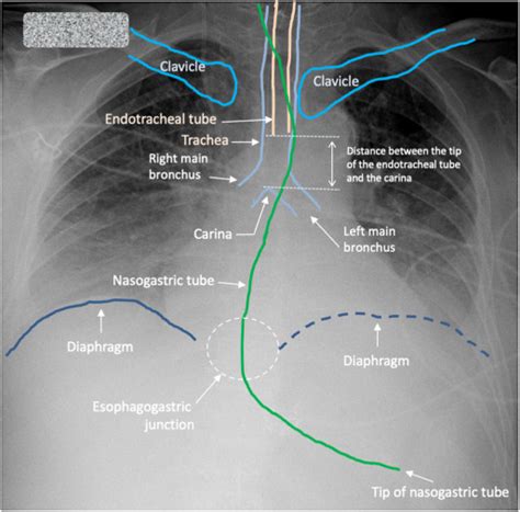 The Accuracy Of Intensive Care Nurses Interpretation Of Chest Radiographs To Recognise