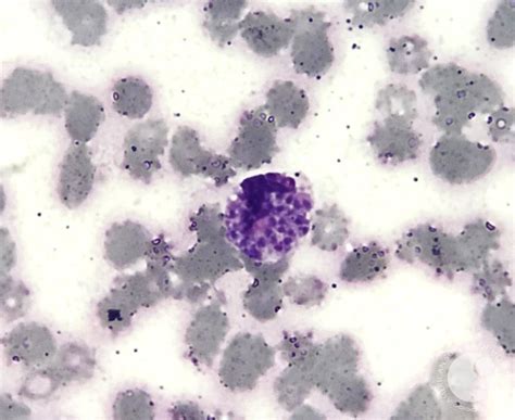 Pseudo Chediak Higashi Granules