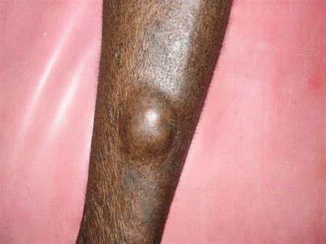 Onchocercoma Subcutaneous Nodule Over Shin Area Download Scientific