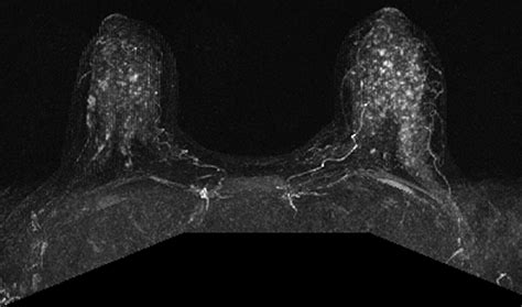 Mri Marked Enhancement At Dennis Aguayo Blog