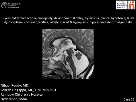 3 Year Old Female With Microcephaly Developmental Delay Dyskinesia Truncal Hypotonia Facial