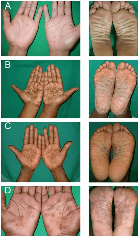 Palmar And Plantar Rash Of Secondary Syphilis Typical Palmar And Download Scientific Diagram