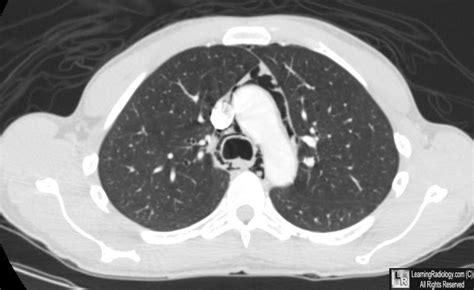 Learningradiology Pneumomediastinum Mediastinal Emphysema Chest