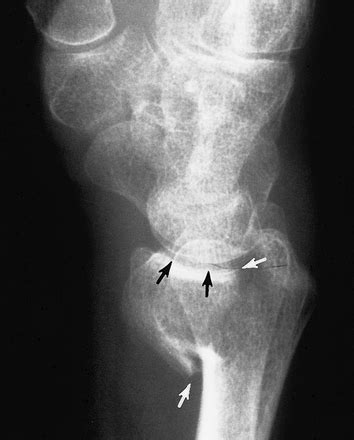 Distal Radius Fractures Trauma Orthobullets