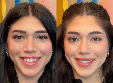 Lip Flip Before And After Photos And Everything You Need To Know