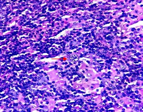 A Rare Occurrence In The Lung Showing A Polymorphous Lymphoid Download Scientific Diagram