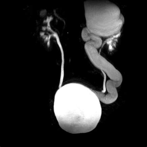 Pdf Uncommon Asymptomatic Unilateral Complete Duplicated Collecting System And Giant Ectopic