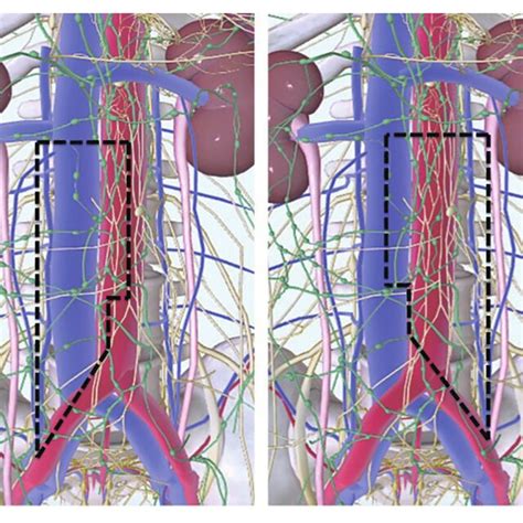 Robot Assisted Retroperitoneal Lymph Node Dissection Template Limits Download Scientific