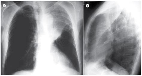 Scielo Brasil Left Upper Lobe Atelectasis Left Upper Lobe Atelectasis