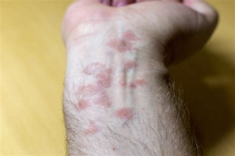 6 Tipos De Eczema Síntomas Y Causas