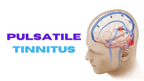 Pulsatile Tinnitus Understanding Symptoms And Treatment Options