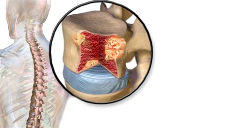 Spine Tumorsarshwikimediablausen Medical Communications Arkansas