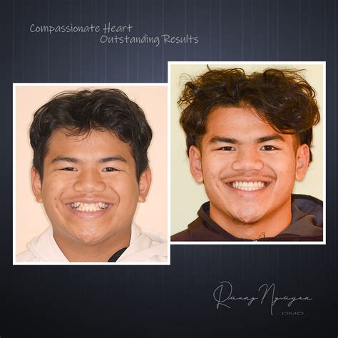 Class Iii Underbite Treated Without Extraction Lawrencevil… Georgia Orthodontic Care Flickr