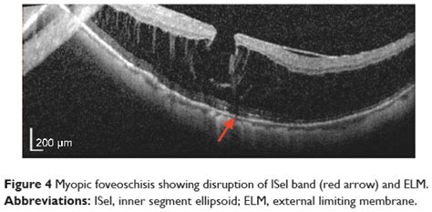 Photoreceptor Inner Segment Ellipsoid Band Integrity On Spectral Domai