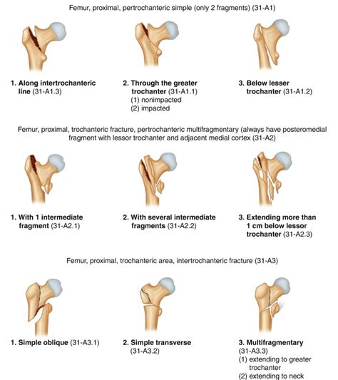 Classification Of Hip Fracture At Bennie Morris Blog