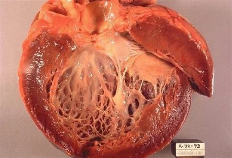 What Is Keshan Disease Symptoms Causes Diagnosis And More Chiid Health