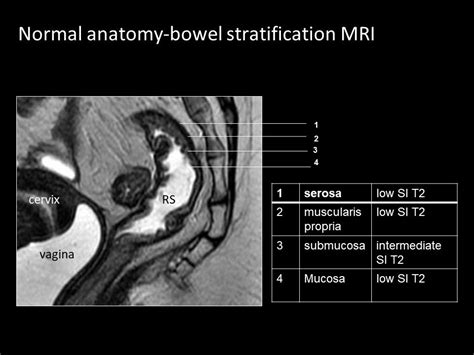 Rectum Anatomy Mri