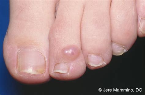 Arthritic Cyst On Foot Cheap Sale