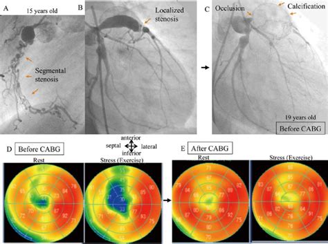 Selective Coronary Angiograms And Myocardial Perfusion Imaging MPI Download Scientific