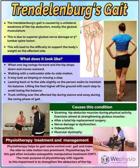 Trendelenburgs Gait 🔵 What Is Aziz Physio Center Facebook