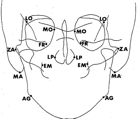 Figure 1 From Craniofacial Form And Obstructive Sleep Apnea In Polynesian And Caucasian Men