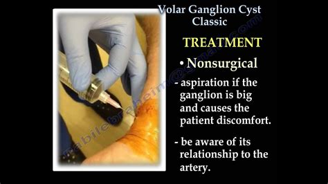 Ganglion Cyst Palmar Wrist