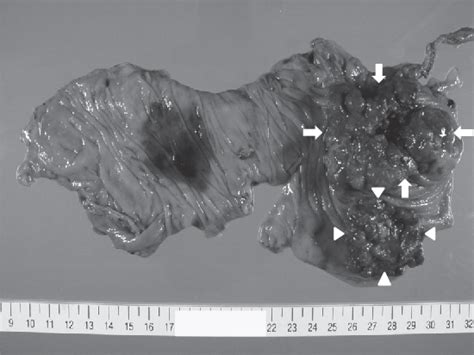 Figure 1 From Colon Cancer With Micropapillary Carcinoma—report Of A Case— Semantic Scholar